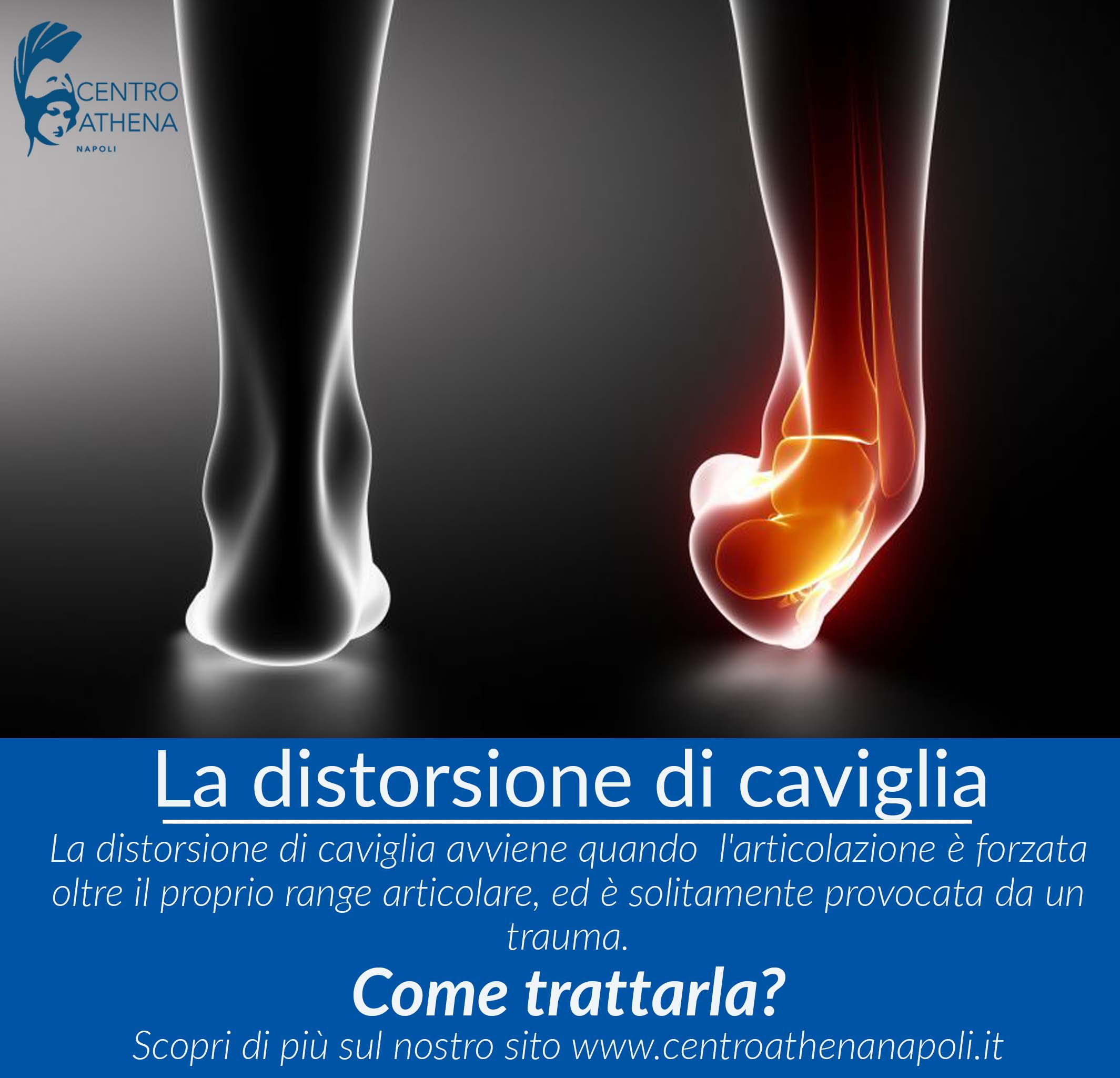 La distorsione di caviglia | Centro Athena Napoli